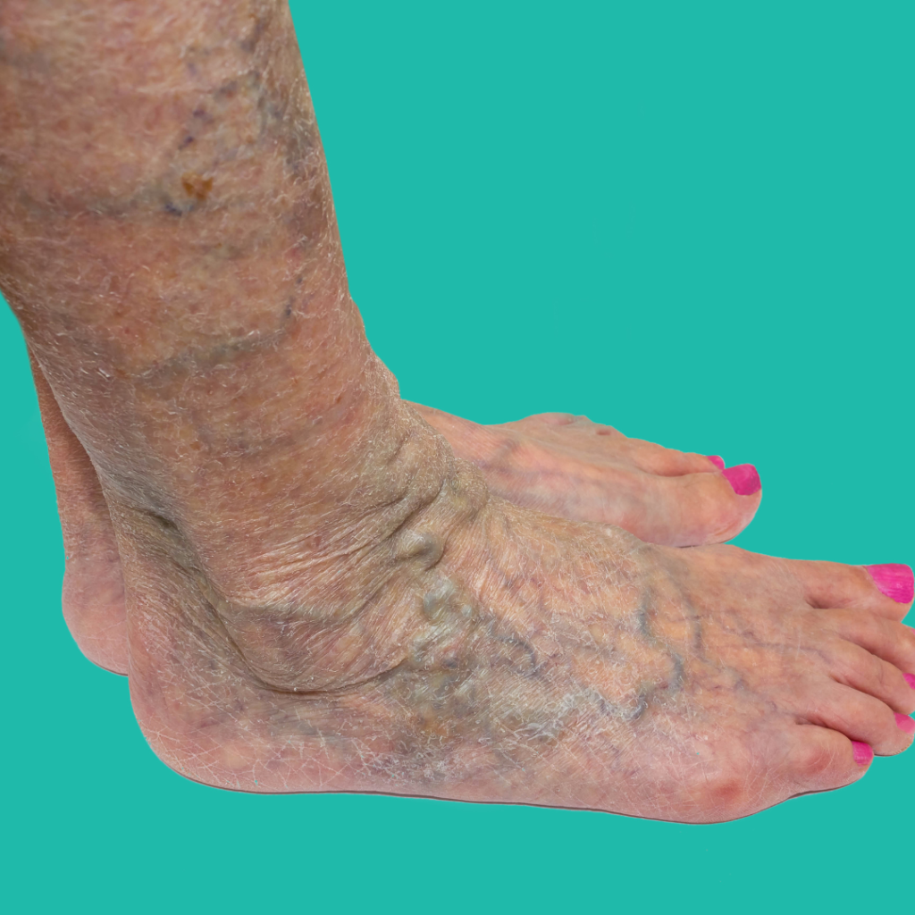 QUAIS SÃO OS ESTÁGIOS DAS VARIZES? - Tratamento de Varizes | Saúde ...